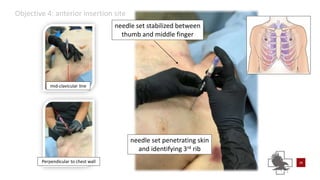 Power point of needle chest compressions | PPTX