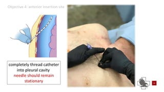 Power point of needle chest compressions | PPTX