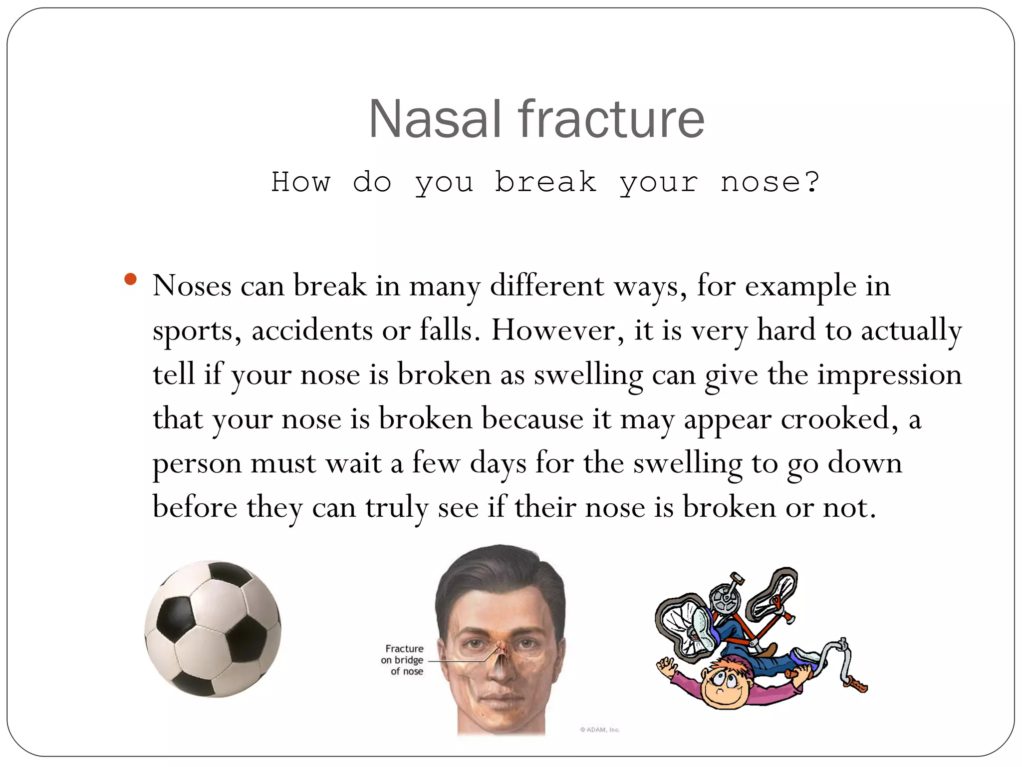 Nasal Fractures | PPT