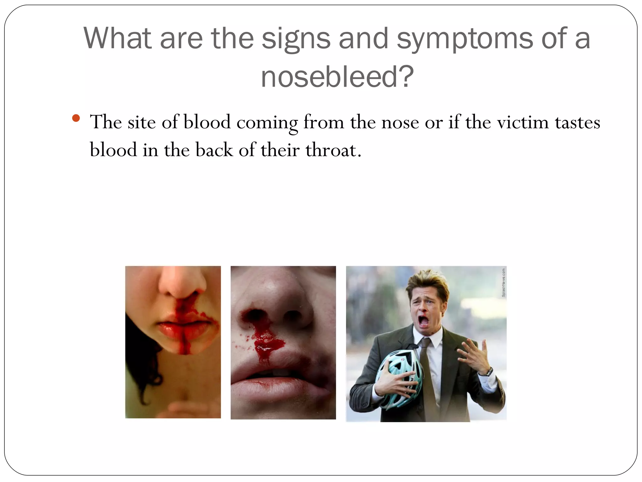 Nasal Fractures | PPT