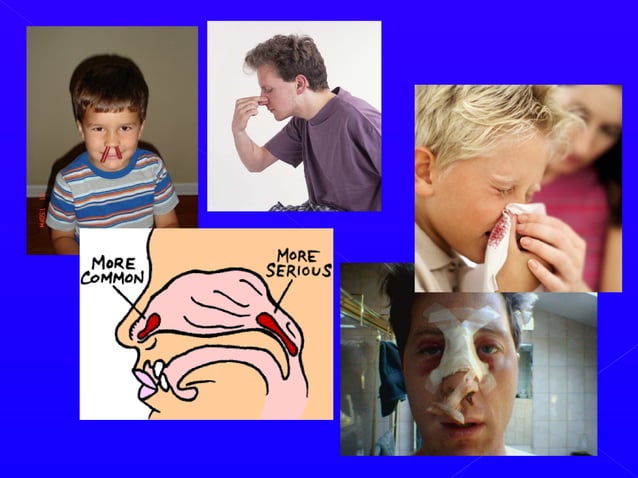 Nasal Injuries | PPT | First Aid | Injuries