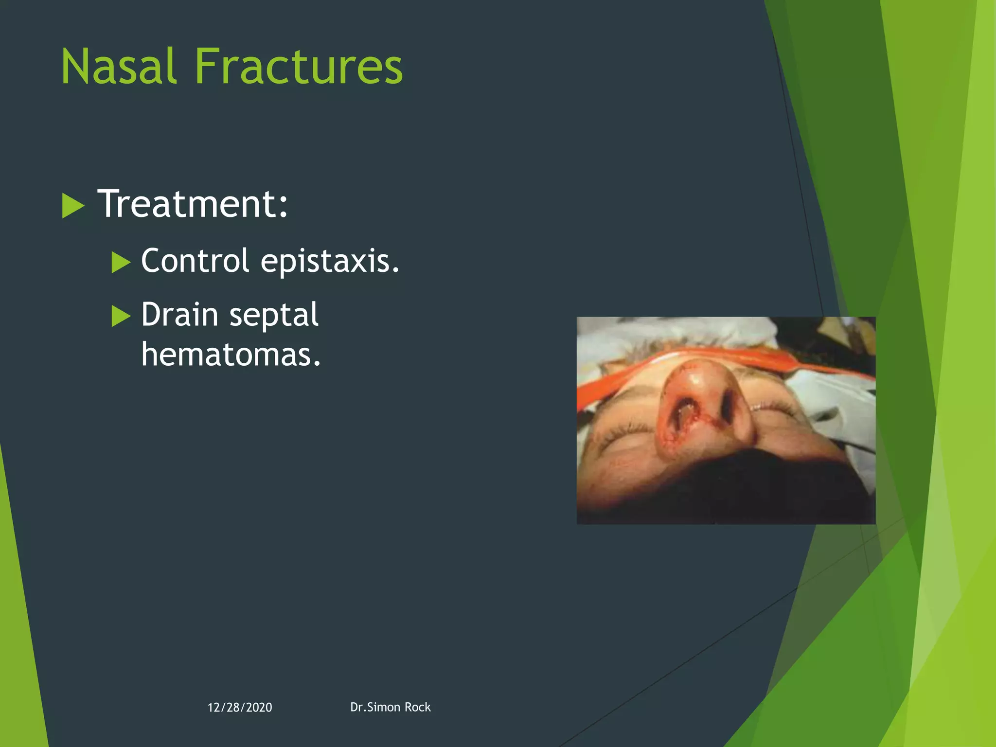 Nasal orbital-ethmoid (noe) fractures | PPT