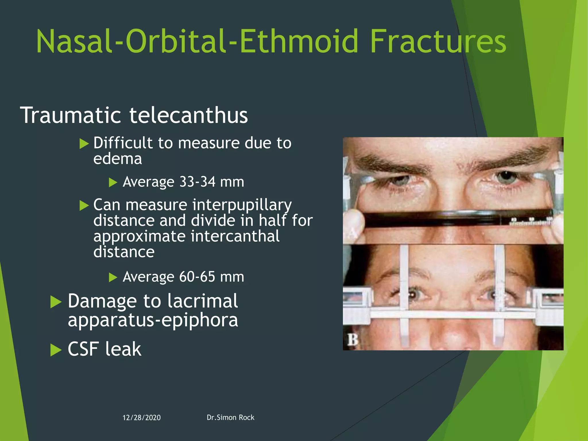 Nasal orbital-ethmoid (noe) fractures | PPT