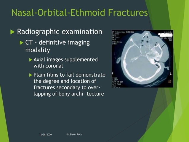 Nasal orbital-ethmoid (noe) fractures | PPT