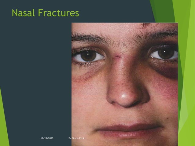 Nasal orbital-ethmoid (noe) fractures | PPT | Free Download