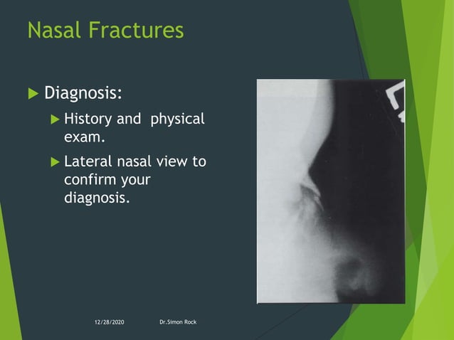 Nasal orbital-ethmoid (noe) fractures | PPT | Free Download