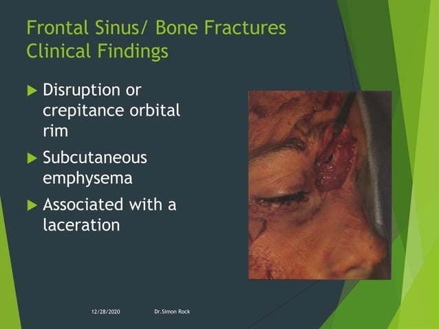 Nasal Orbital Ethmoid Noe Fractures Ppt