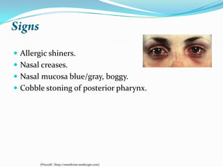 Nasal allergy | PPTX
