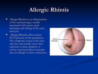Nasal Allergy:Laser Treatment in India | PPT