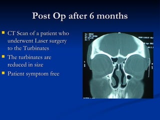 Nasal Allergy:Laser Treatment in India | PPT
