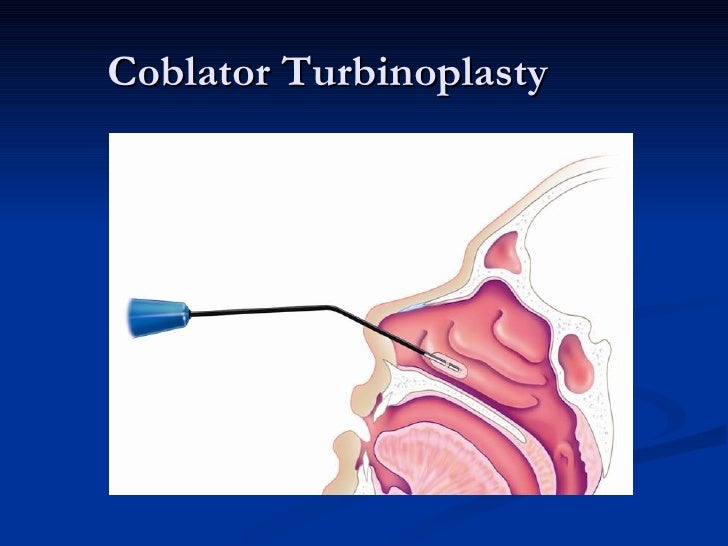 Nasal Allergy:Laser Treatment in India