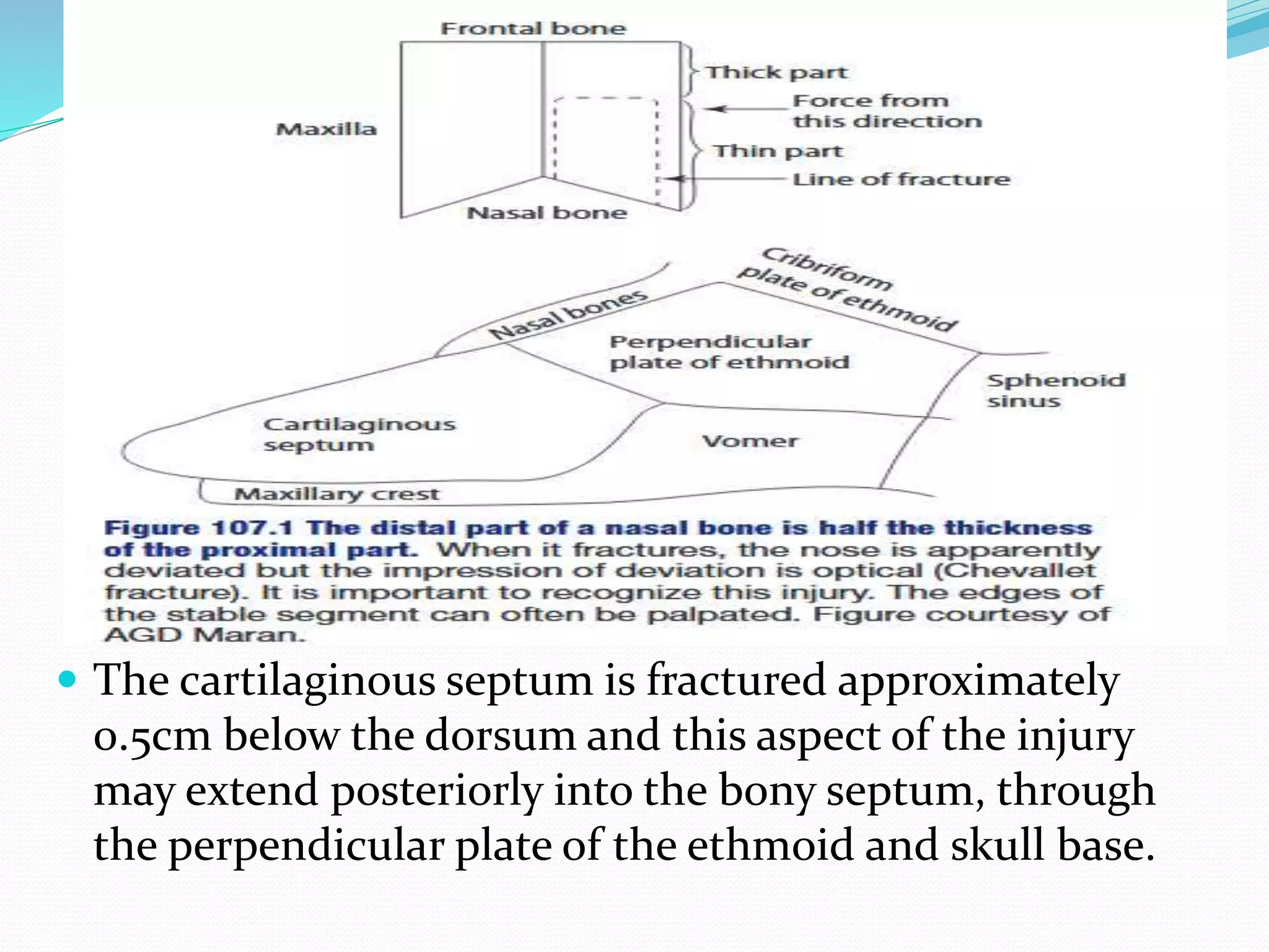 Nasal and facial fractures | PPTX