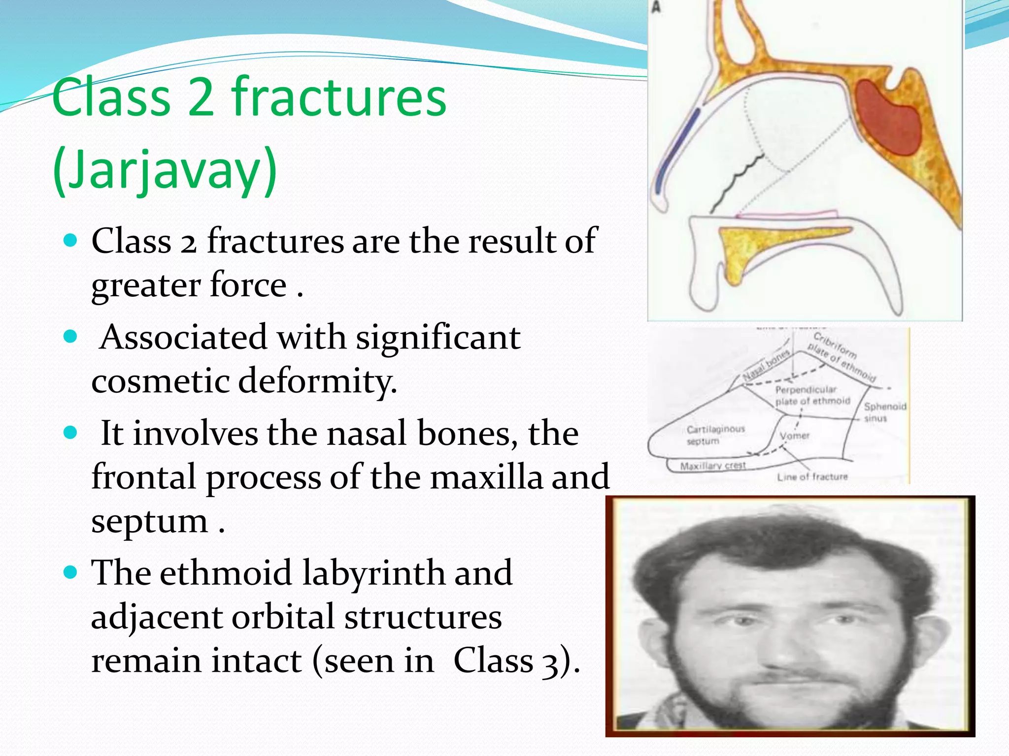 Nasal and facial fractures | PPTX