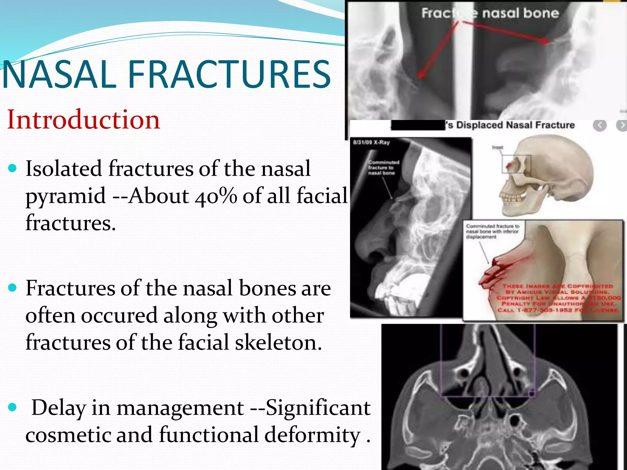 Nasal and facial fractures | PPTX