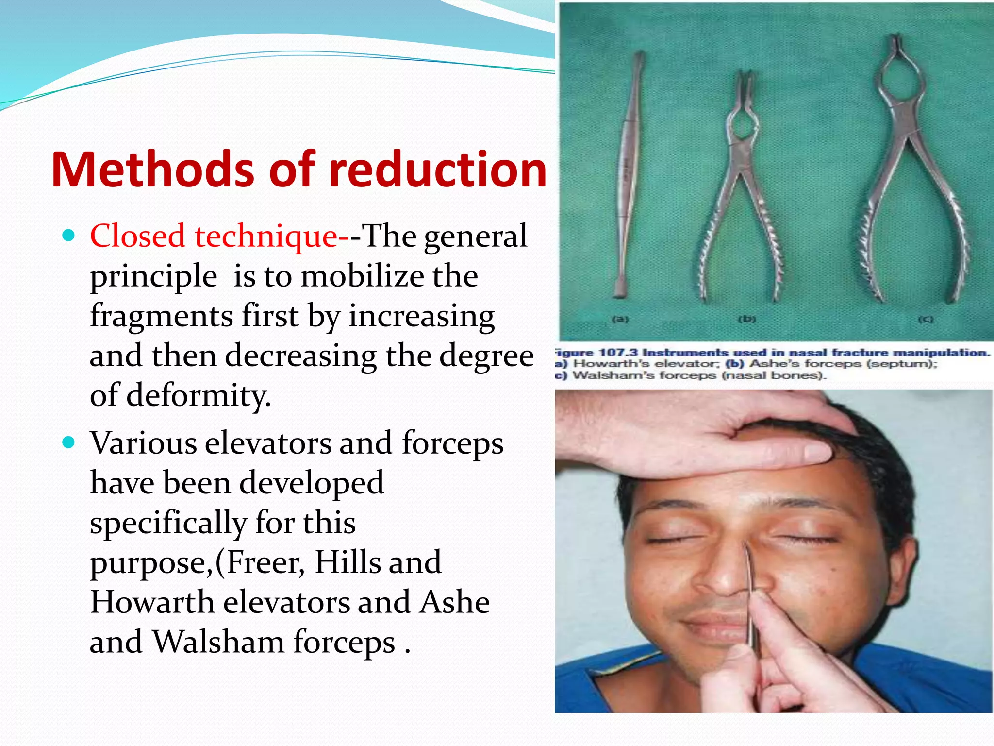 Nasal and facial fractures | PPTX