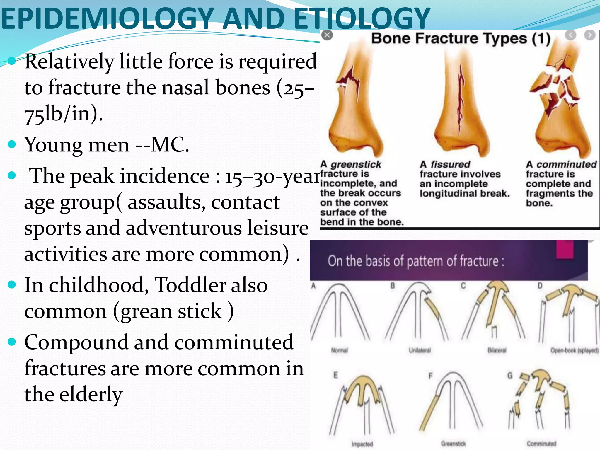 Nasal and facial fractures | PPTX