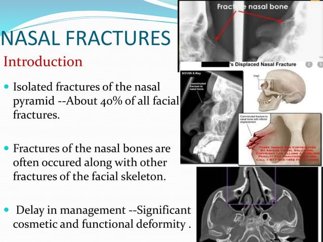 Nasal and facial fractures | PPTX
