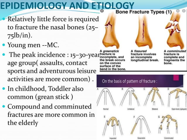 Nasal and facial fractures | PPTX
