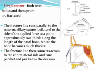 Nasal and facial fractures | PPTX