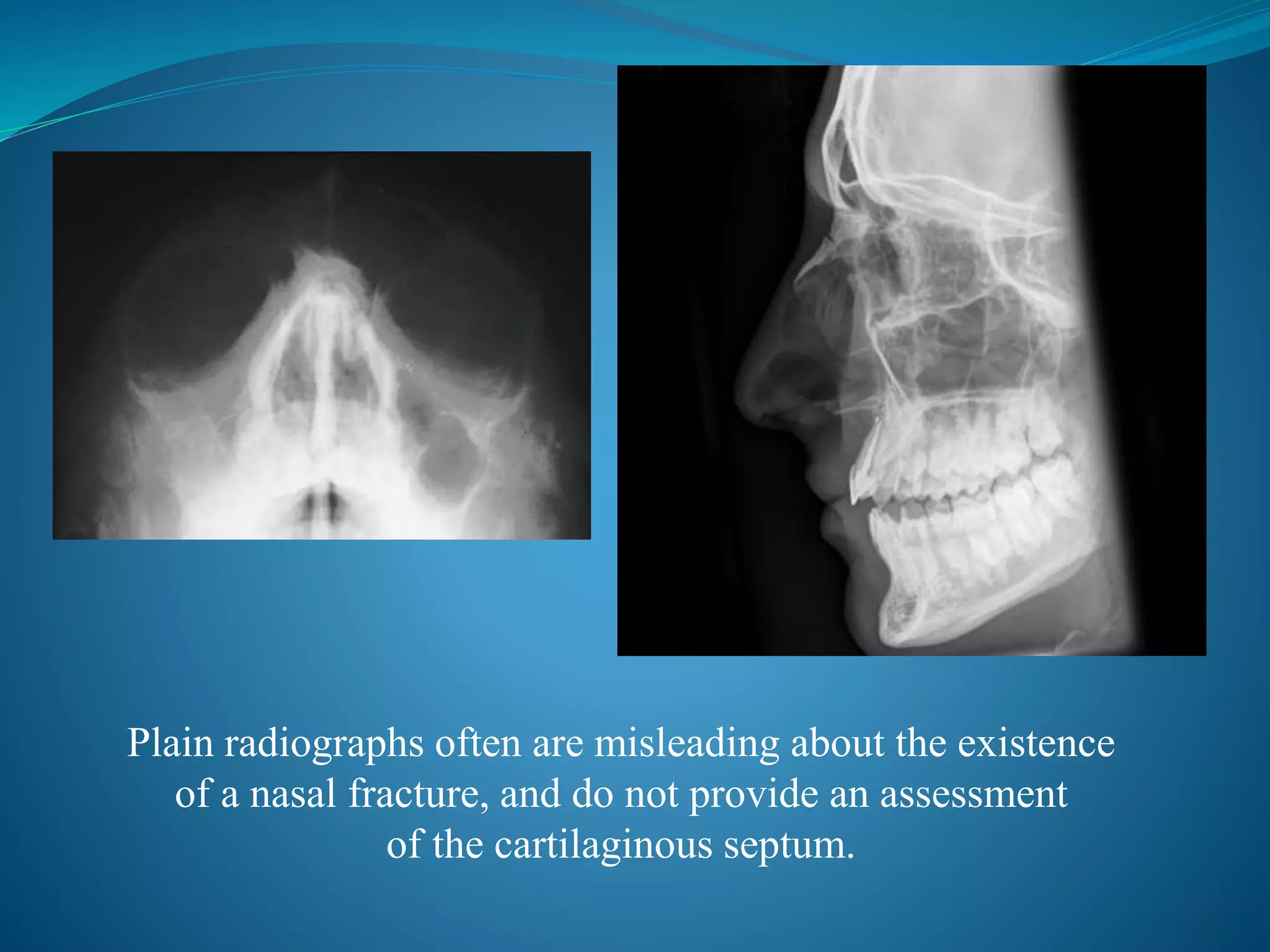 Nasal and nasoethmoidal fractures | PPTX