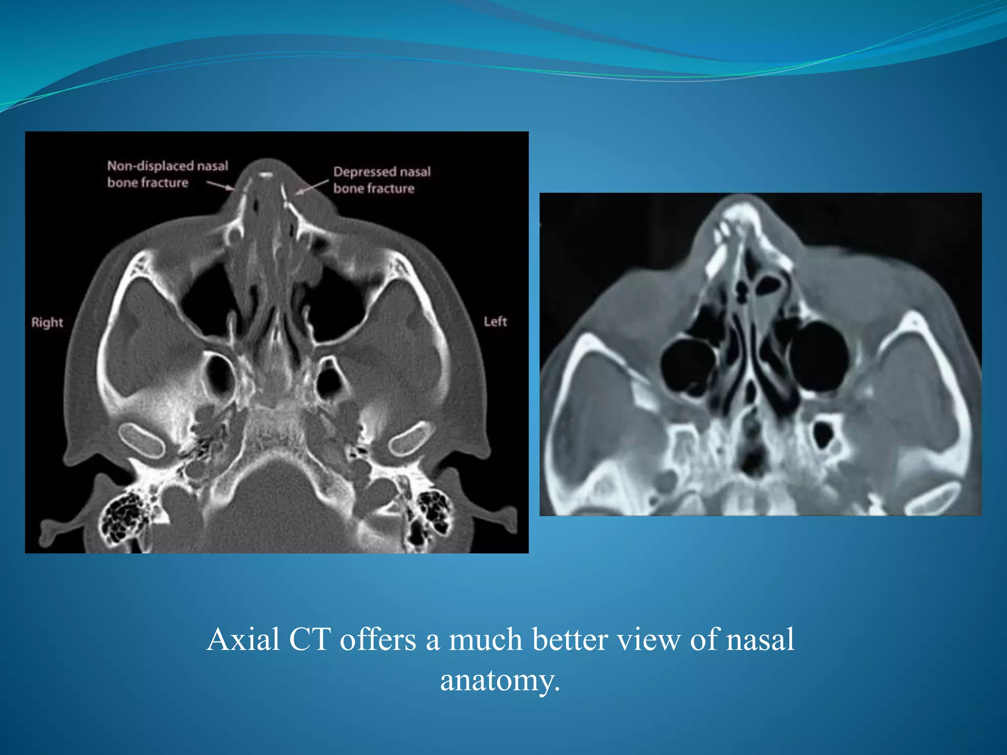 Nasal and nasoethmoidal fractures | PPTX