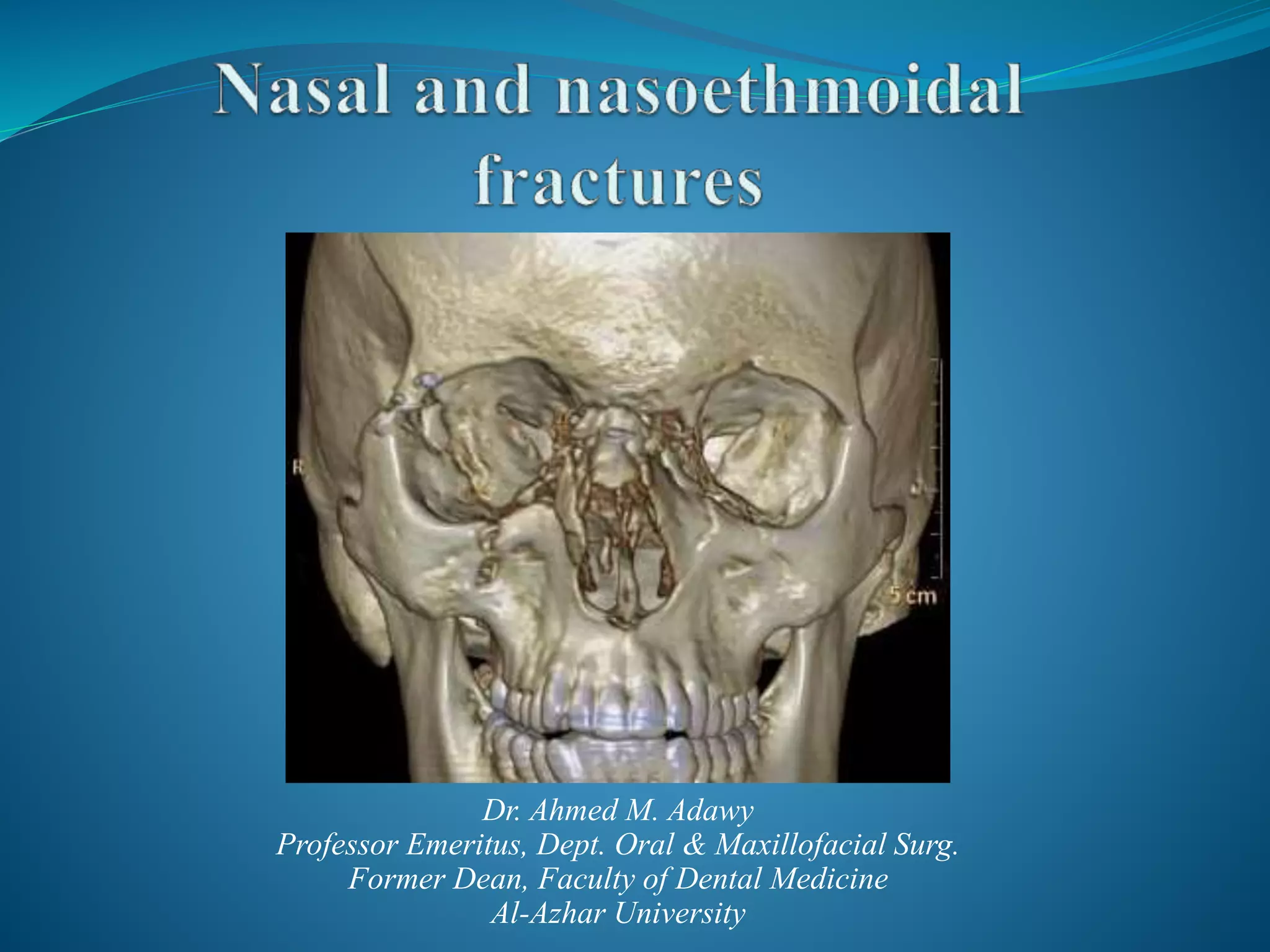Nasal and nasoethmoidal fractures | PPTX
