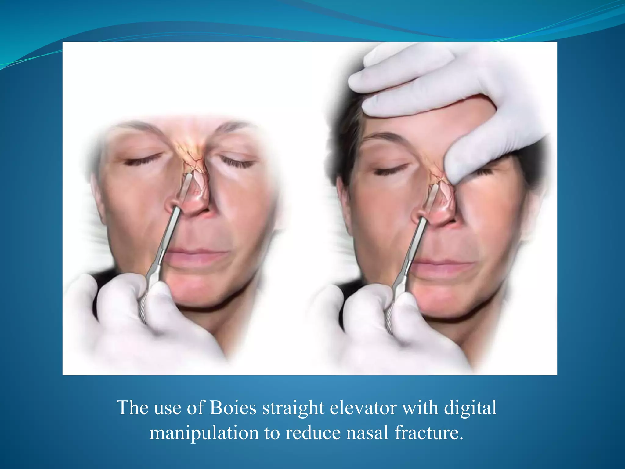 Nasal and nasoethmoidal fractures | PPTX