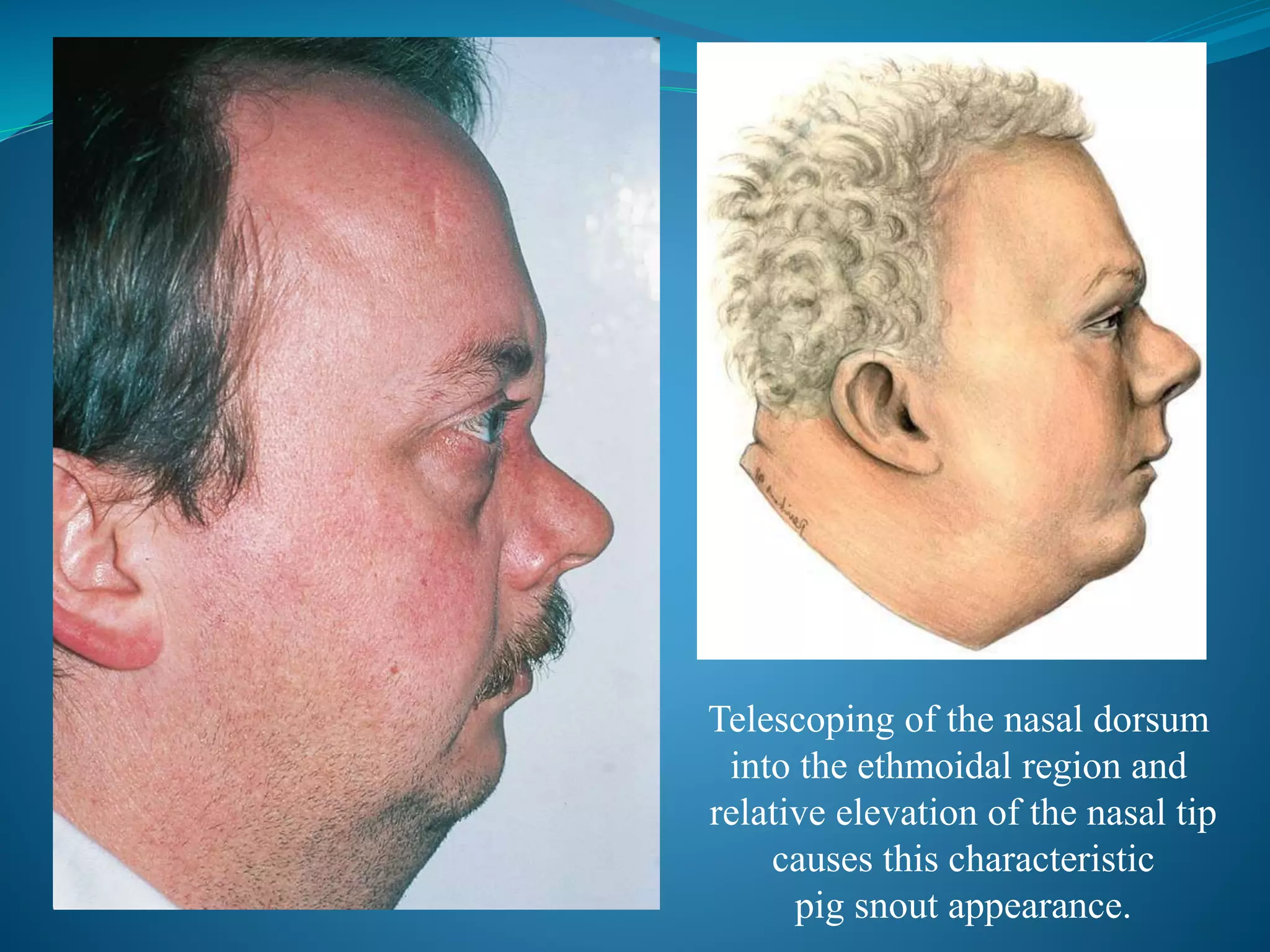 Nasal and nasoethmoidal fractures | PPTX