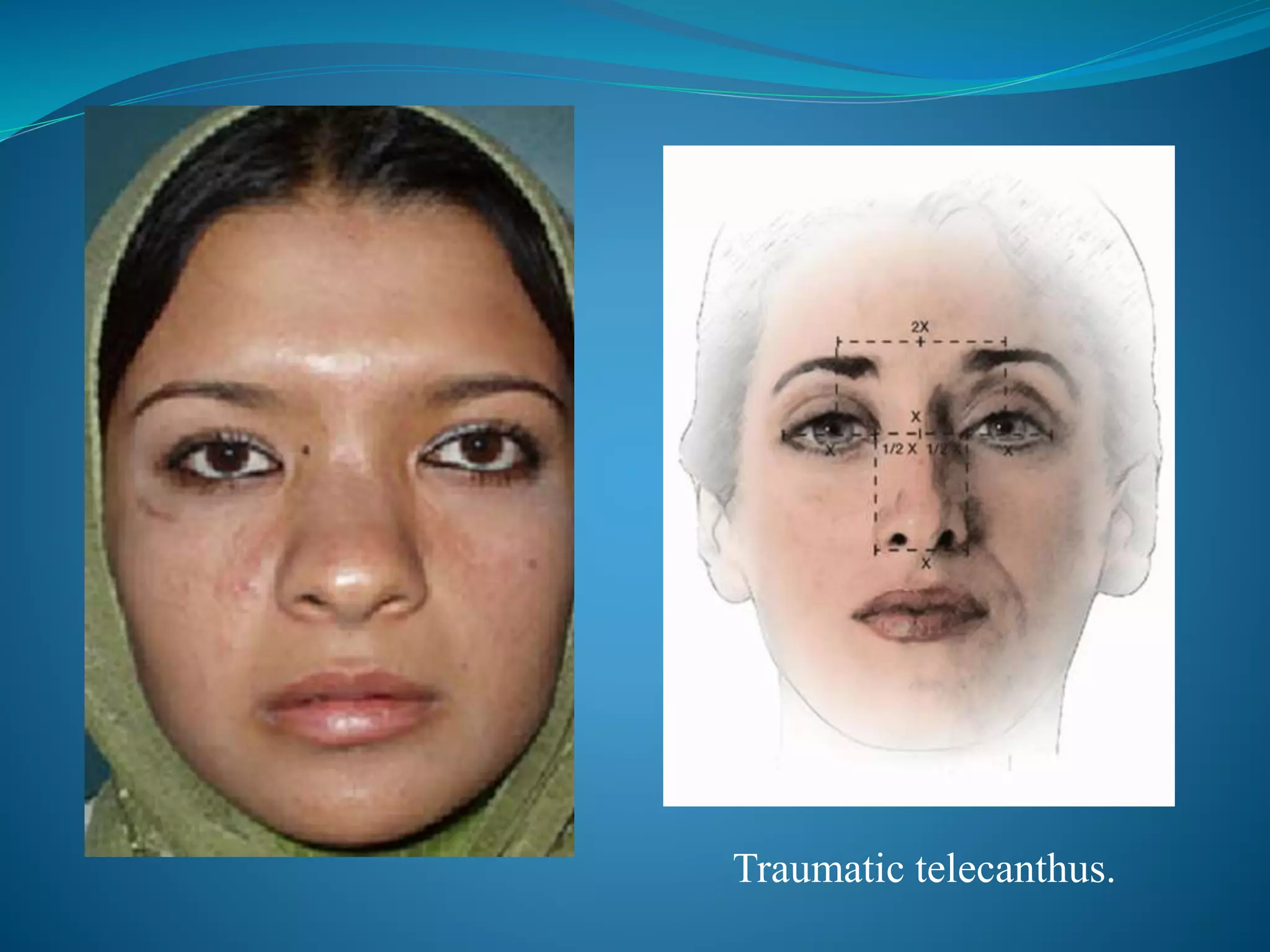 Nasal and nasoethmoidal fractures | PPTX