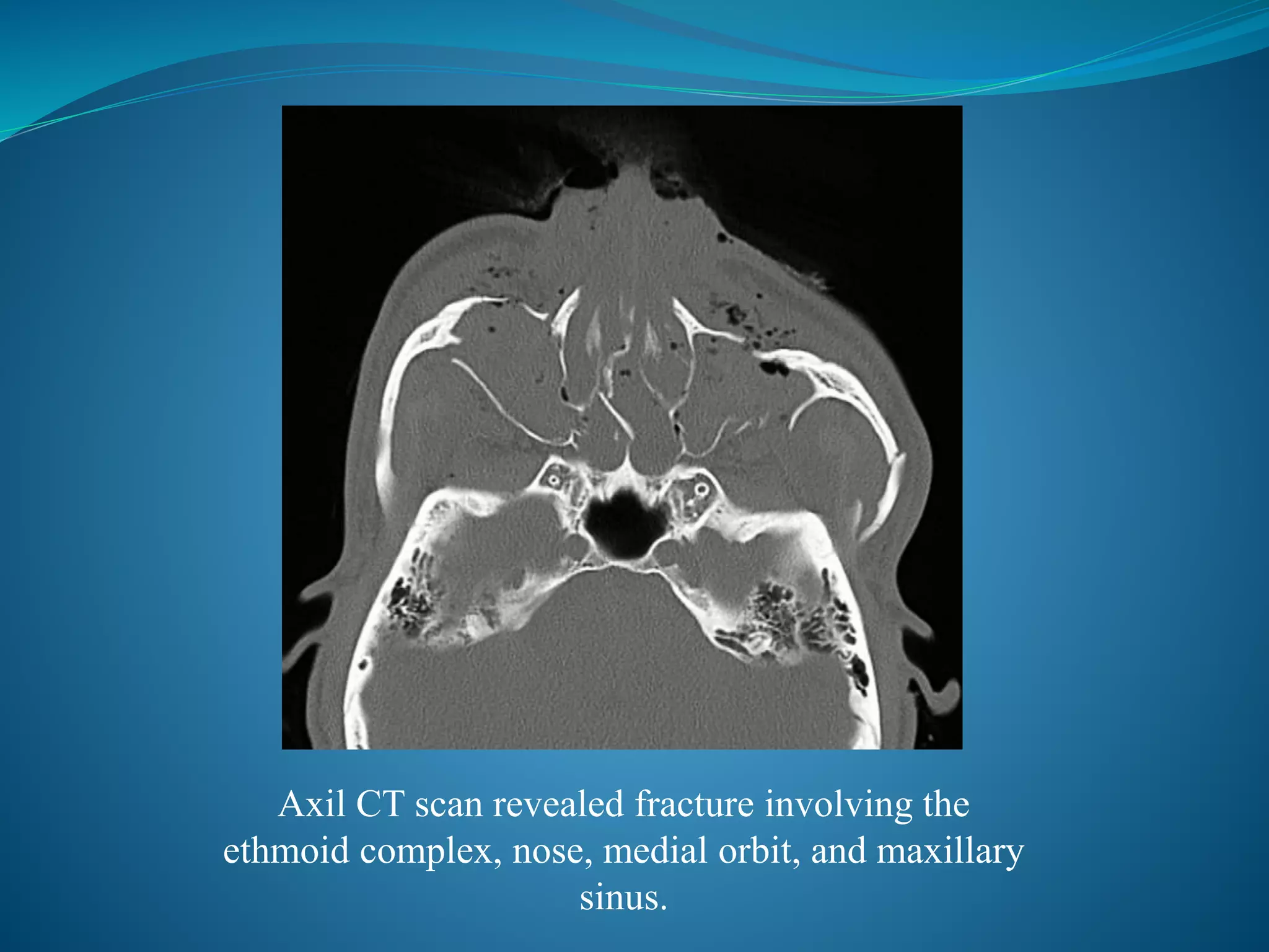 Nasal and nasoethmoidal fractures | PPTX