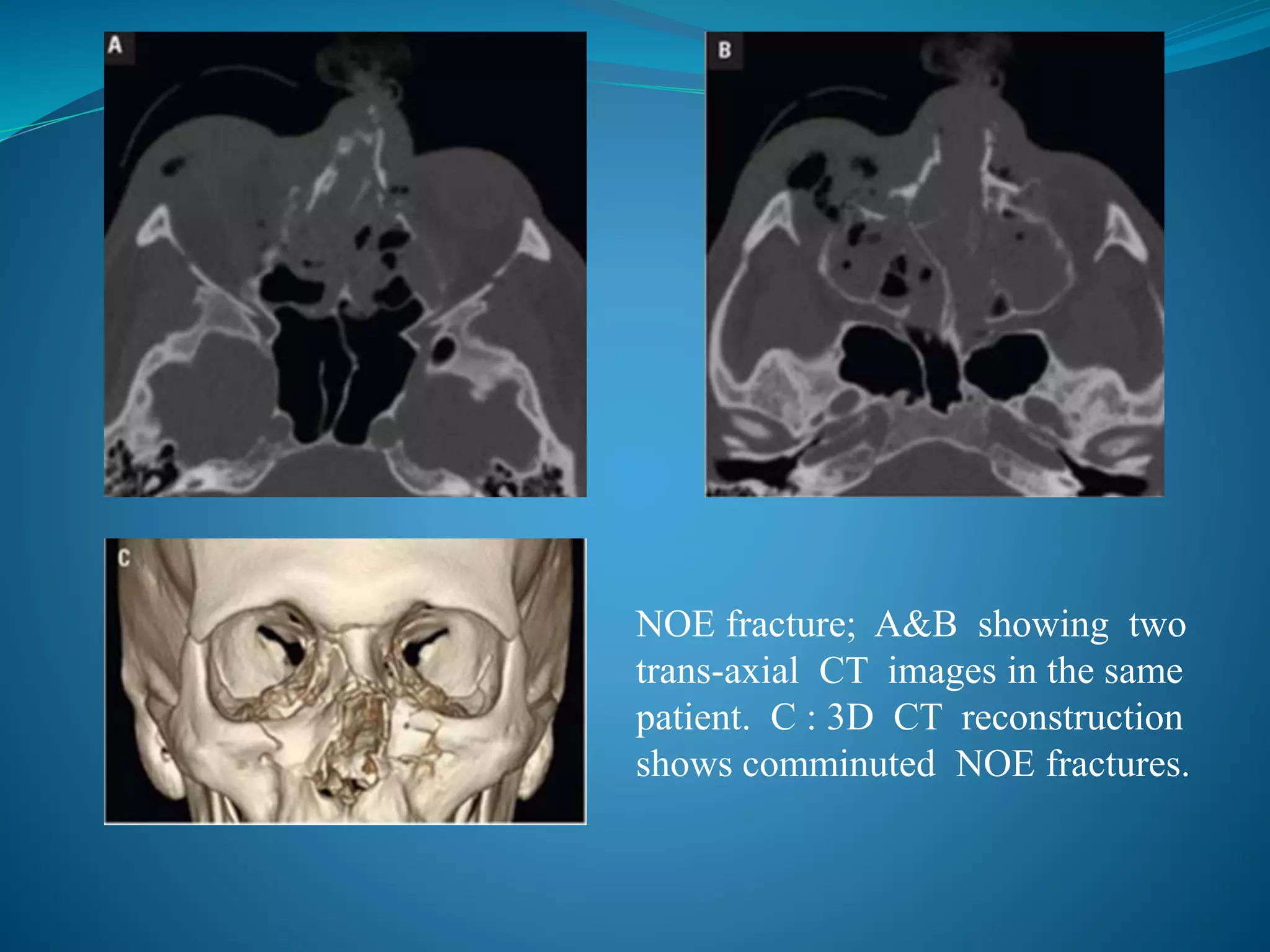 Nasal and nasoethmoidal fractures | PPTX