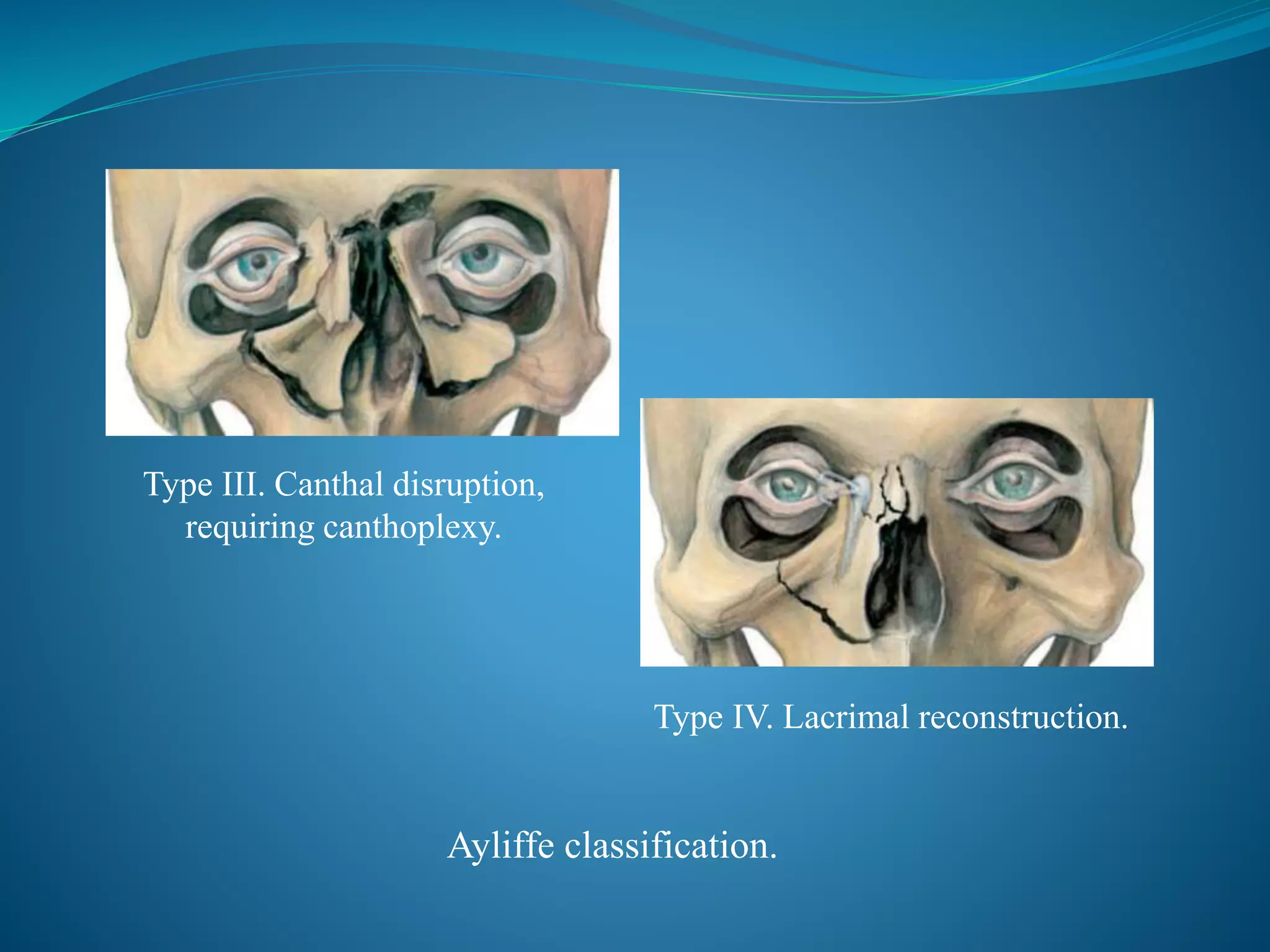 Nasal and nasoethmoidal fractures | PPTX
