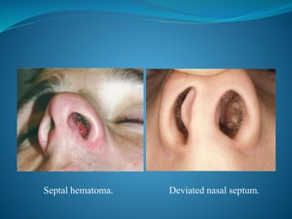 Nasal and nasoethmoidal fractures | PPTX