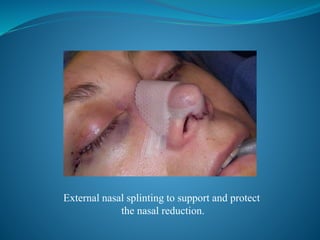 Nasal and nasoethmoidal fractures | PPTX