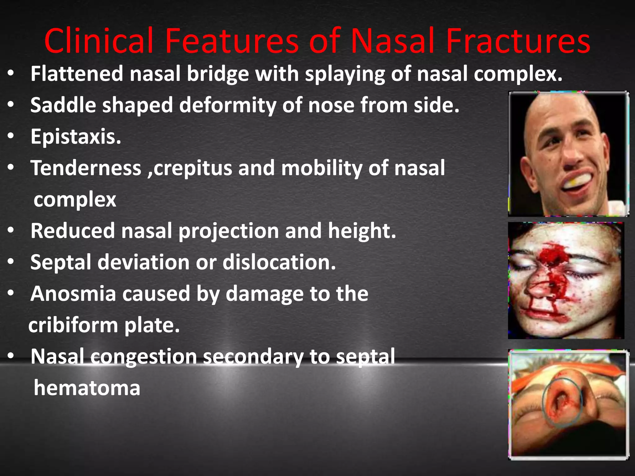 Nasal and noe fractures | PPTX