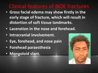 Nasal and noe fractures | PPTX