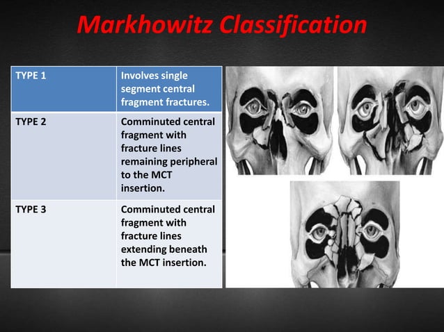 Nasal and noe fractures | PPTX