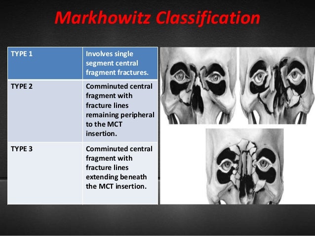 Nasal and noe fractures