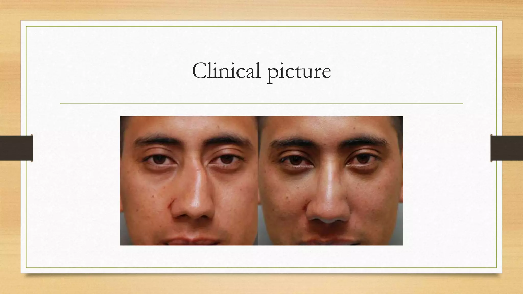Nasal Bone Fracture Pptx