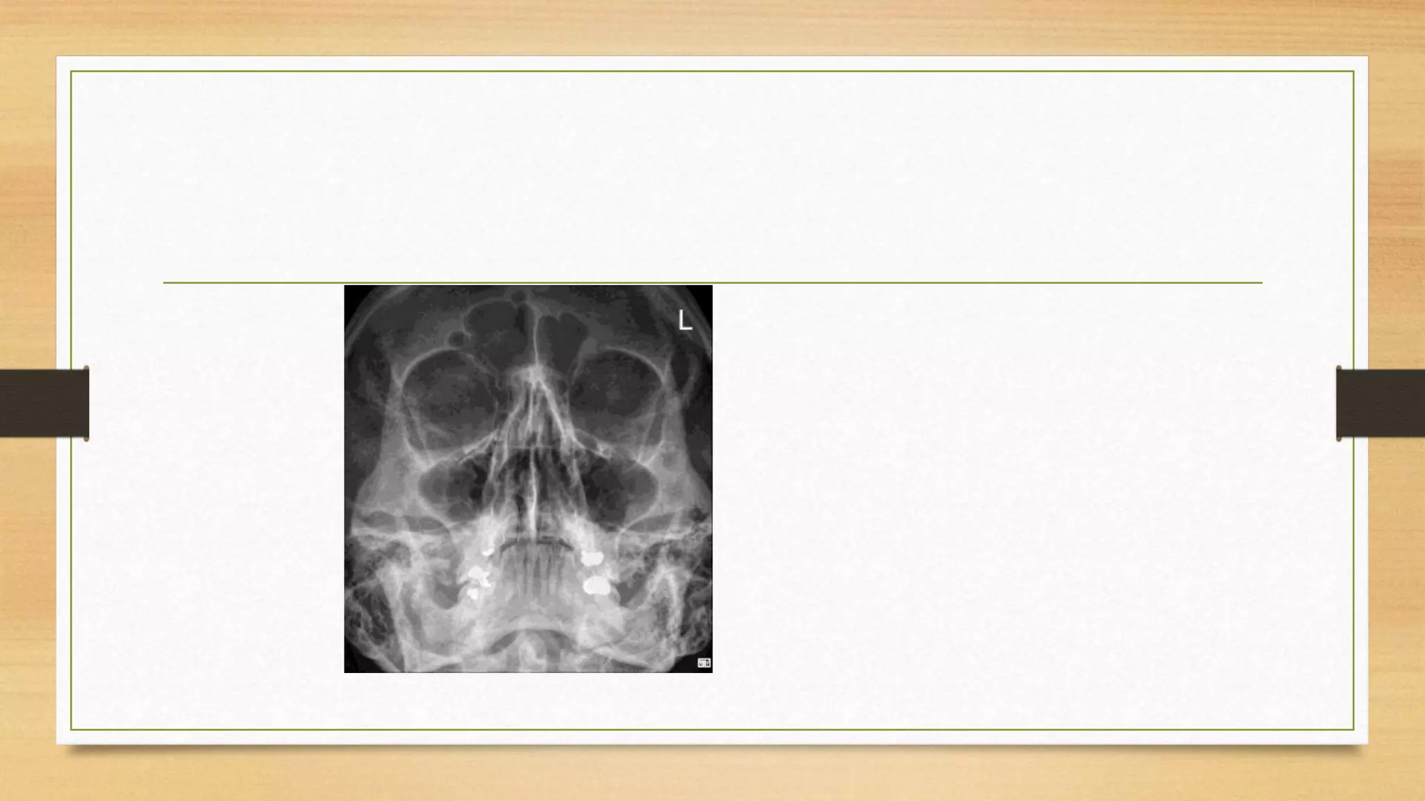 Nasal bone fracture | PPTX