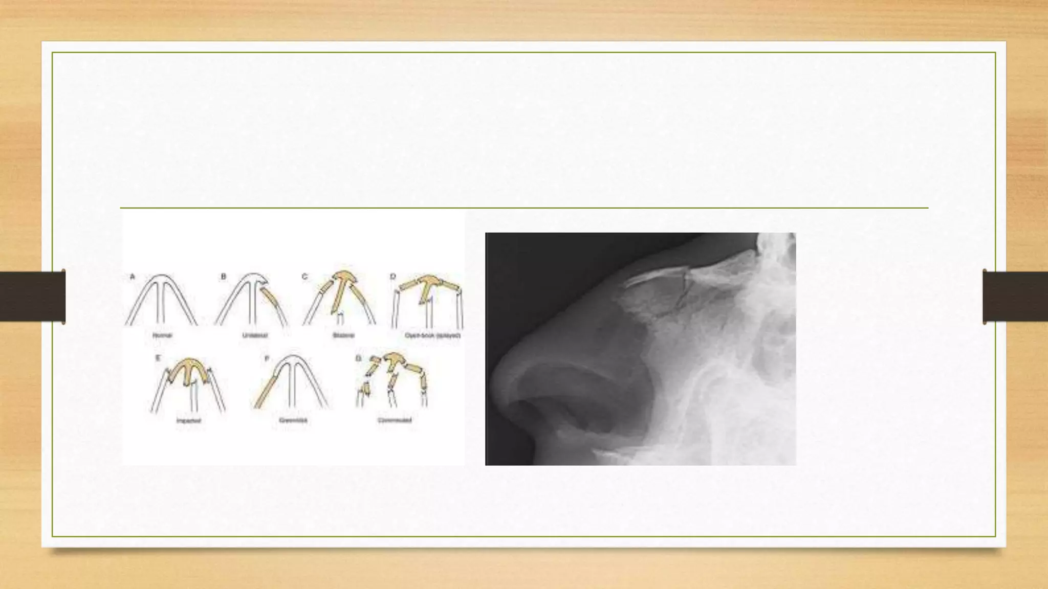 Nasal Bone Fracture Pptx