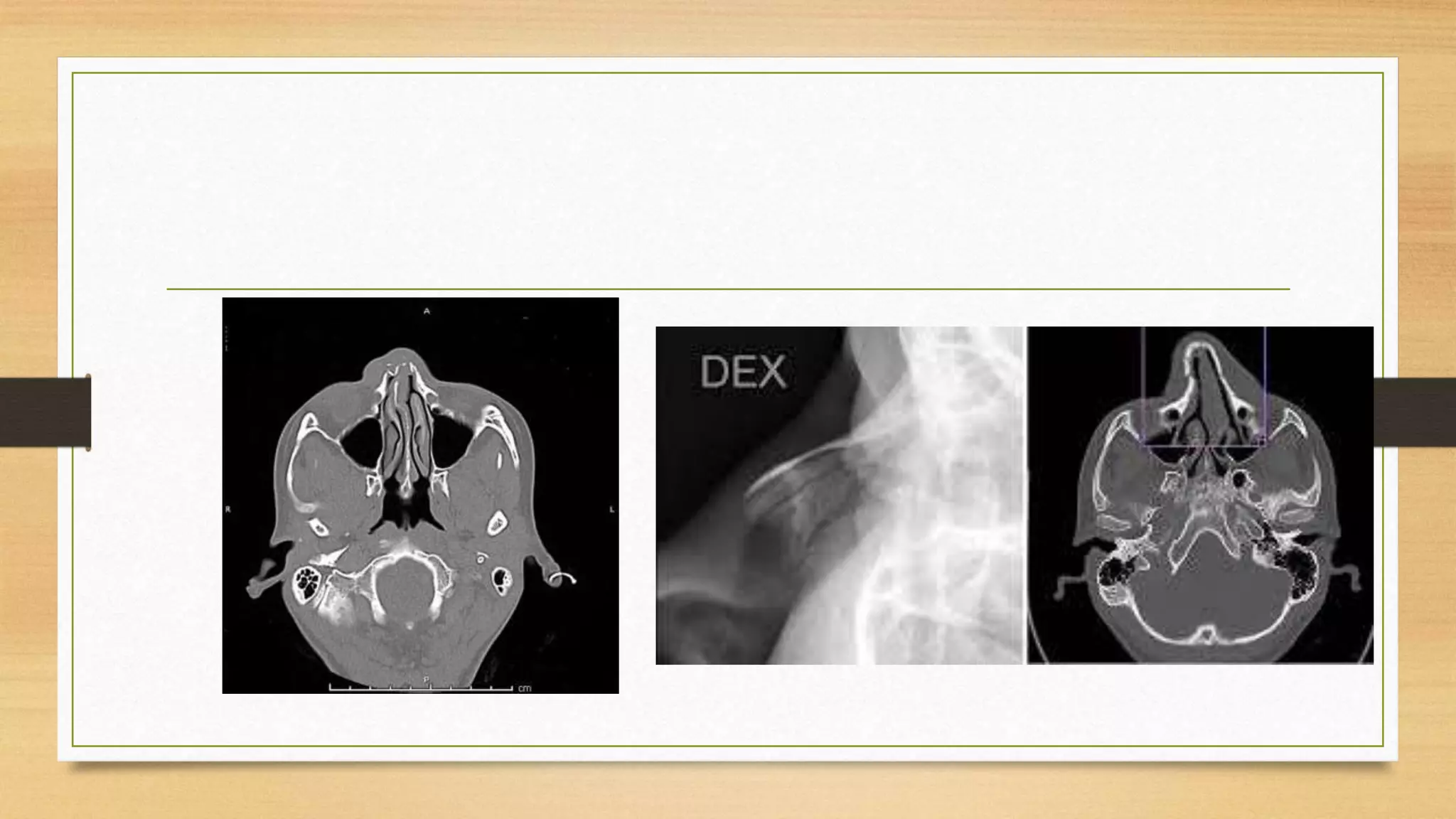 Nasal Bone Fracture Pptx