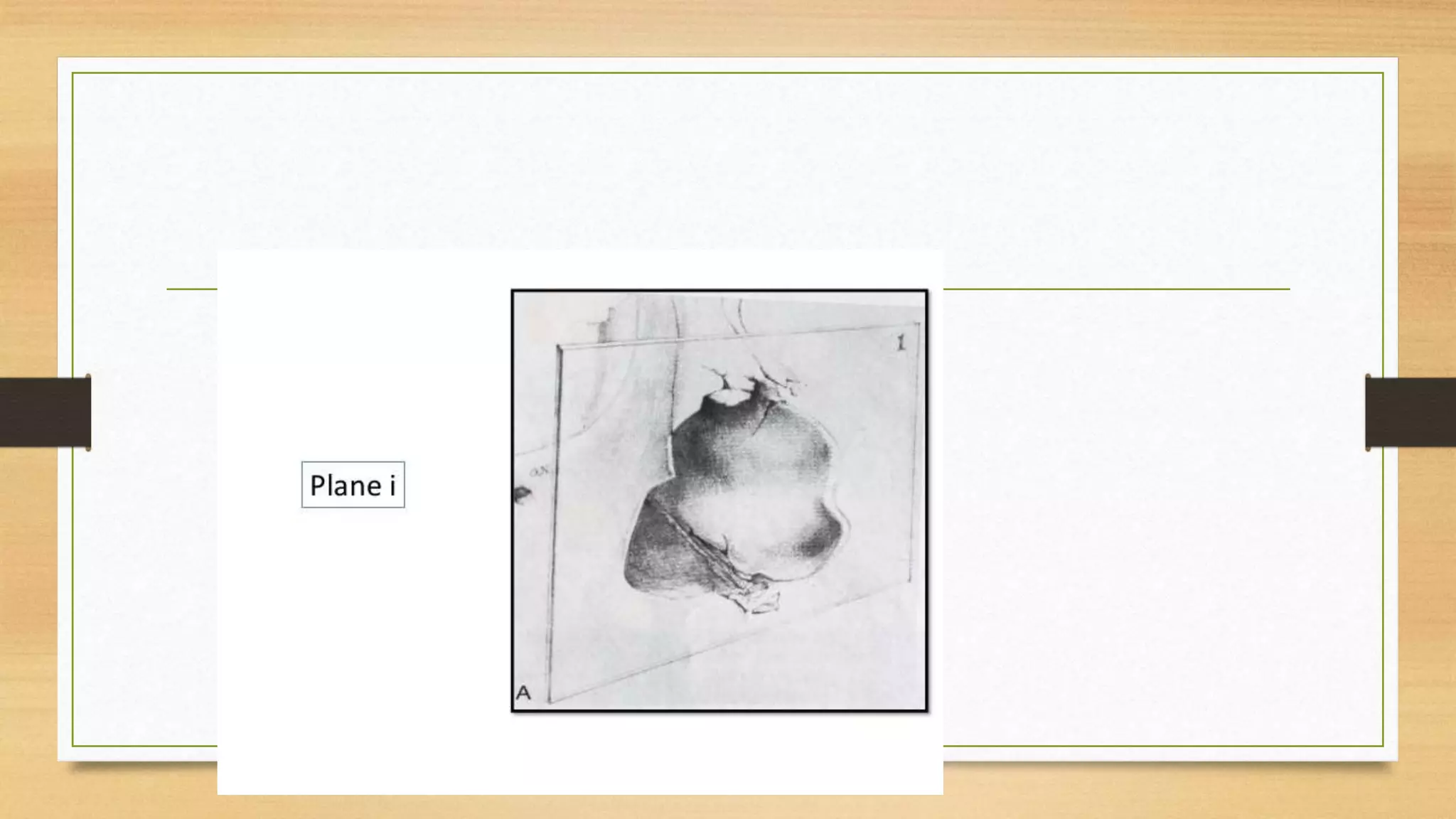 Nasal Bone Fracture Pptx