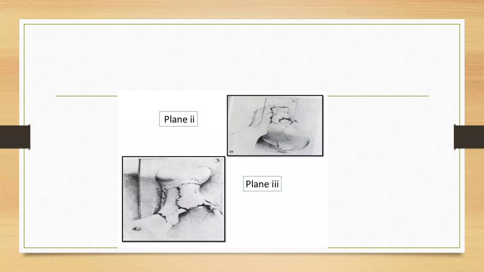 Nasal Bone Fracture Pptx