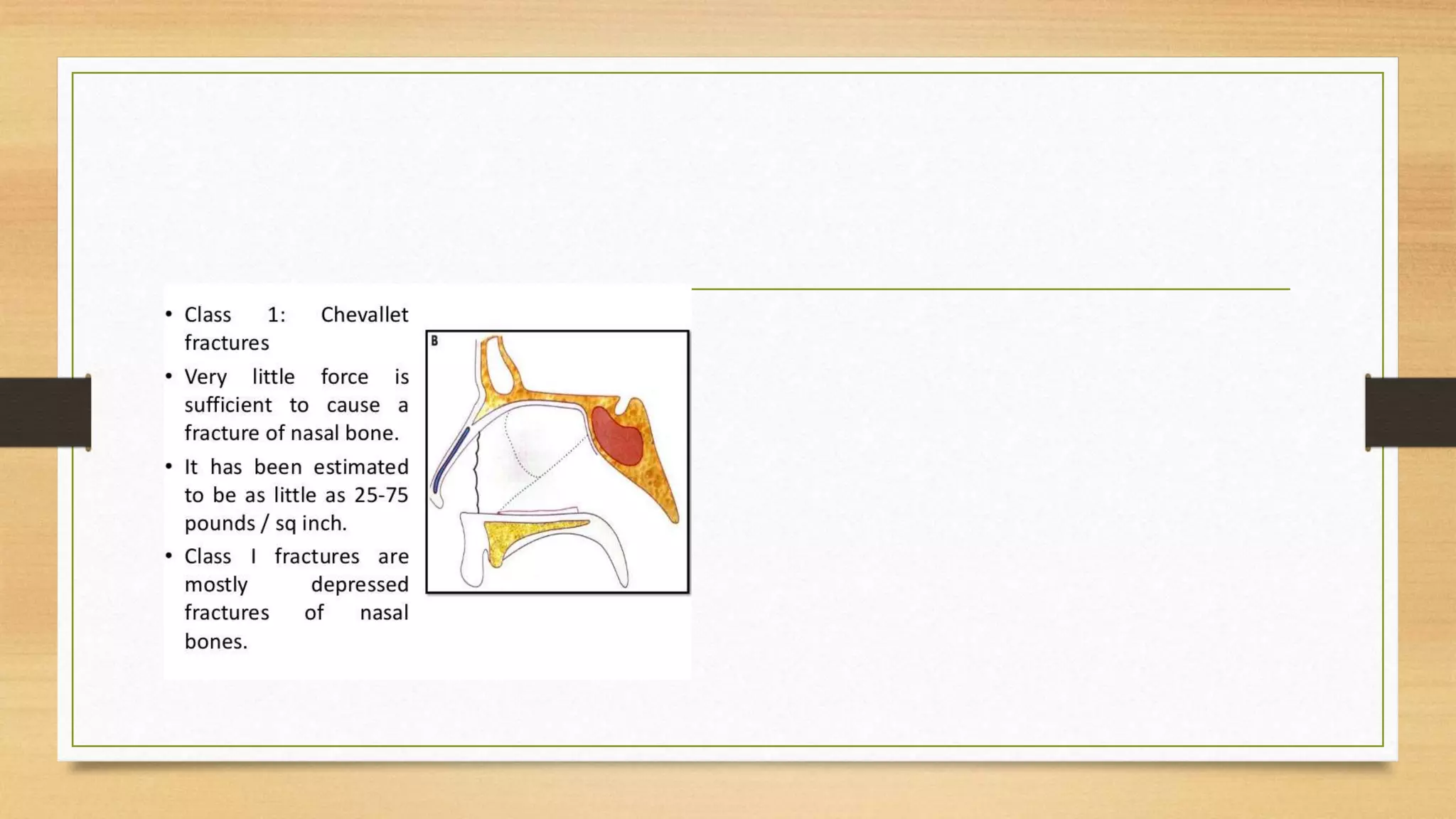 Nasal Bone Fracture Pptx