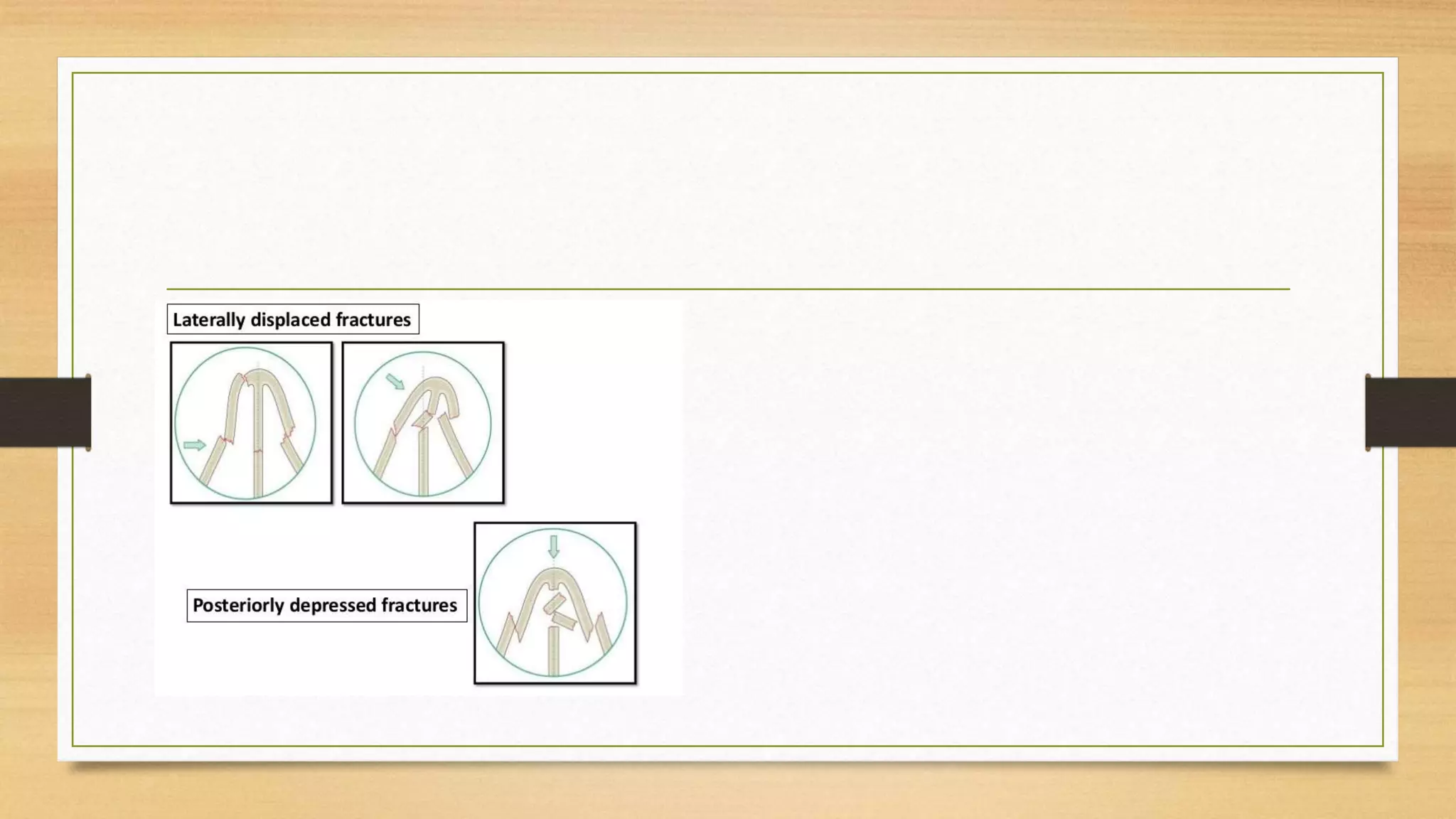 Nasal Bone Fracture Pptx