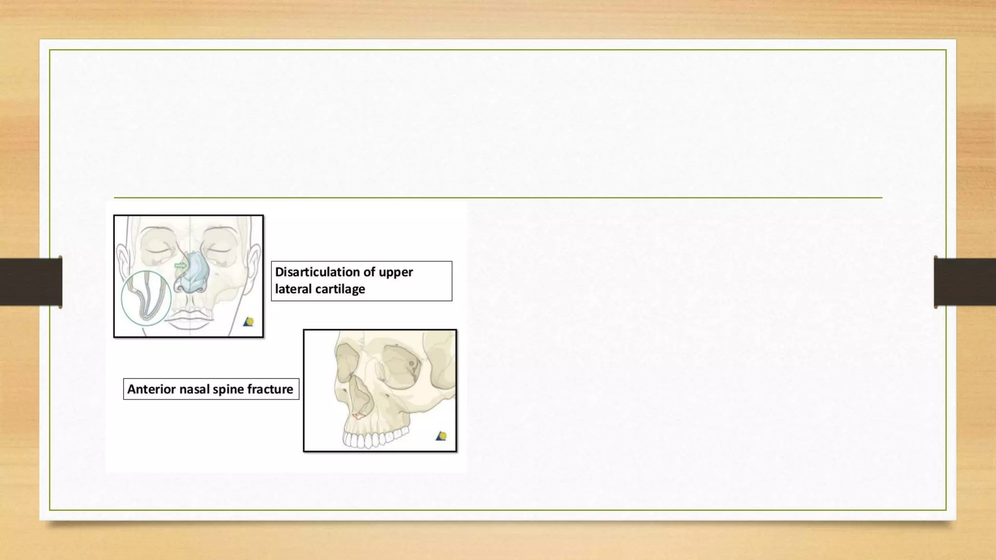 Nasal Bone Fracture Pptx