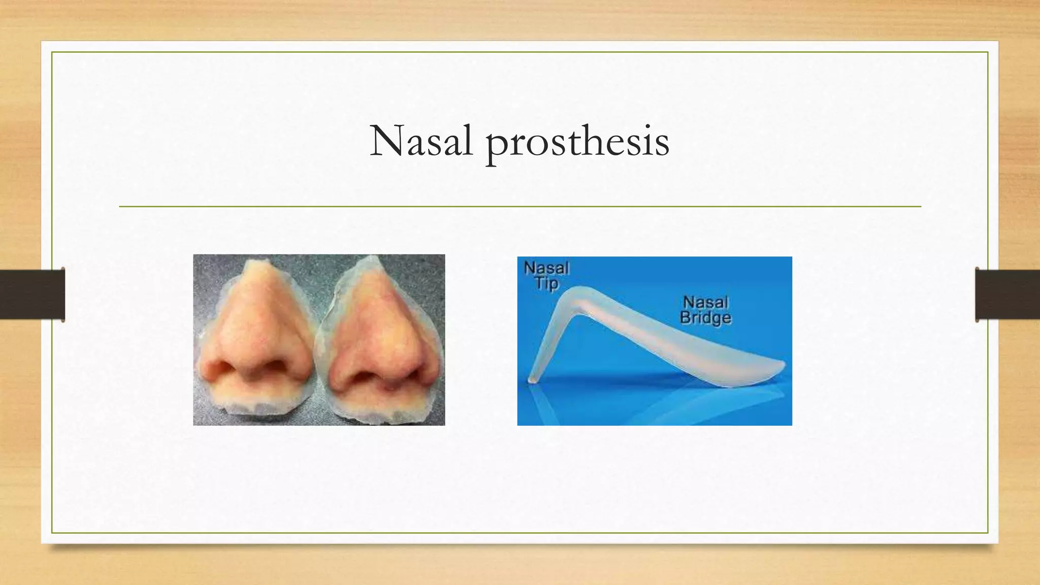 Nasal bone fracture | PPTX