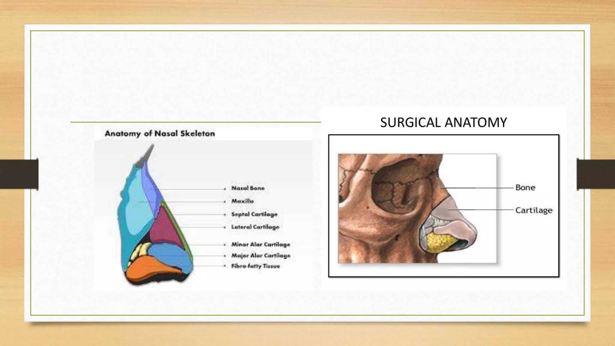 Nasal bone fracture | PPTX