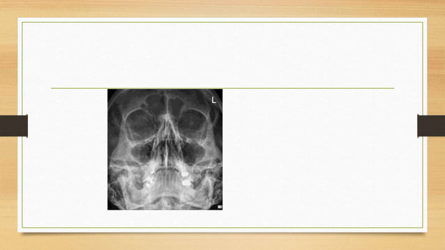 Nasal Bone Fracture Pptx